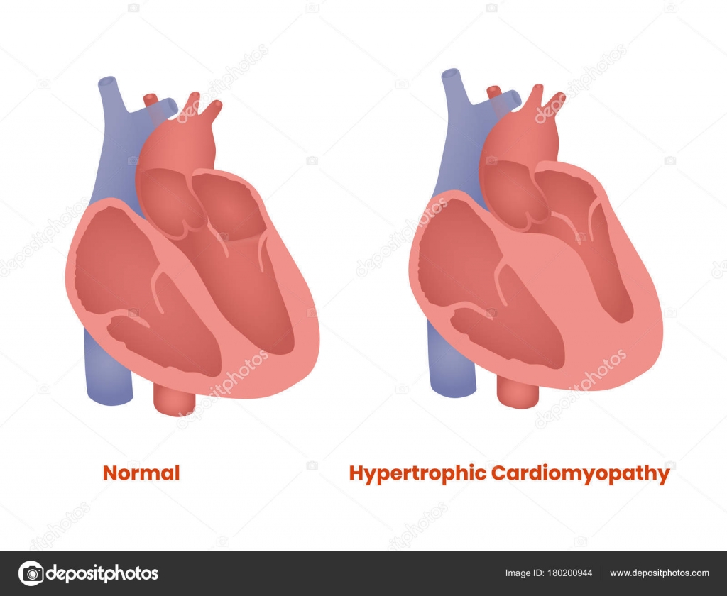 Normal Heart and hypertrophic heart. Hypertrophic Cardiomyopathy vector ...