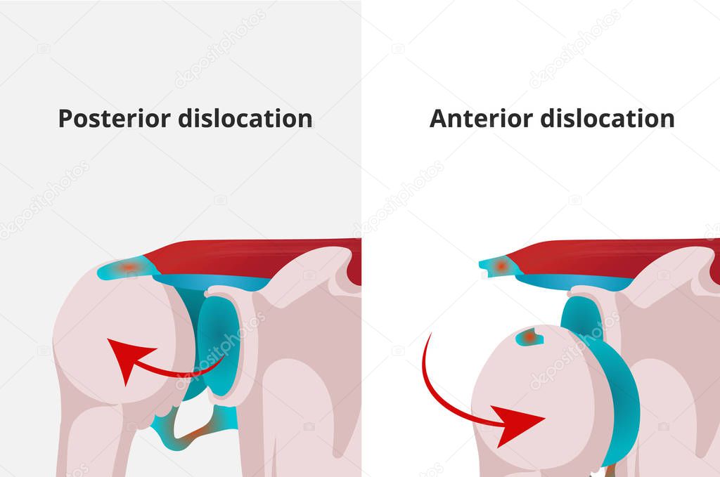 Ilustración del vector de dislocación anterior y posterior del hombro 2024