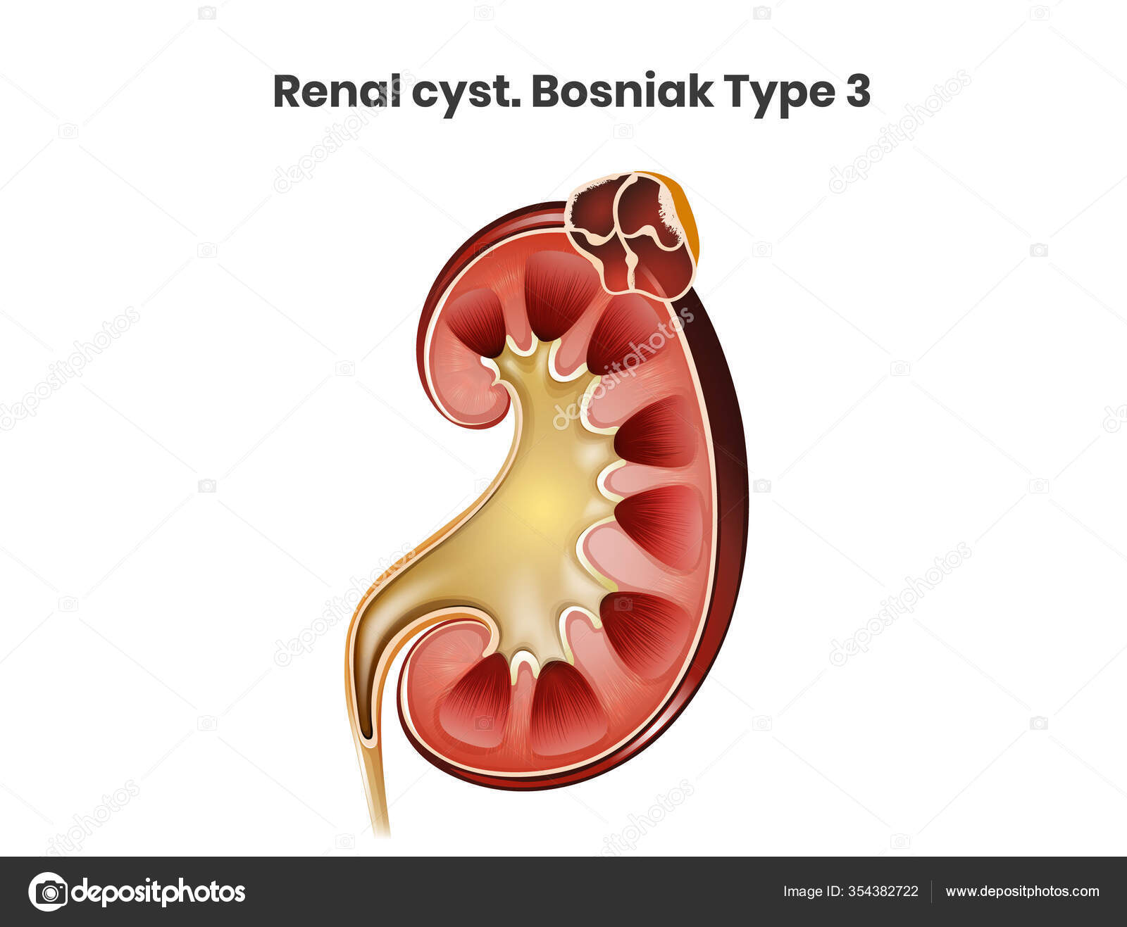 Bosniak 1 PDF) Evaluation Of Bosniak Type IIF And III Renal Cysts With