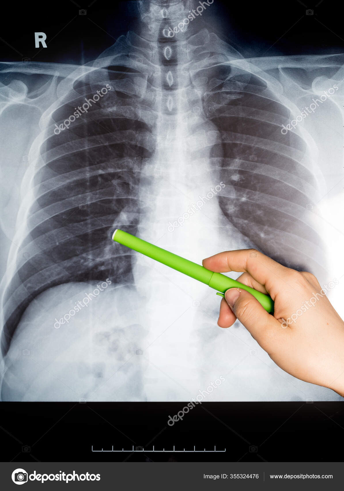 Scan Normal Lung — Stock Photo © badboydt7 #355324476