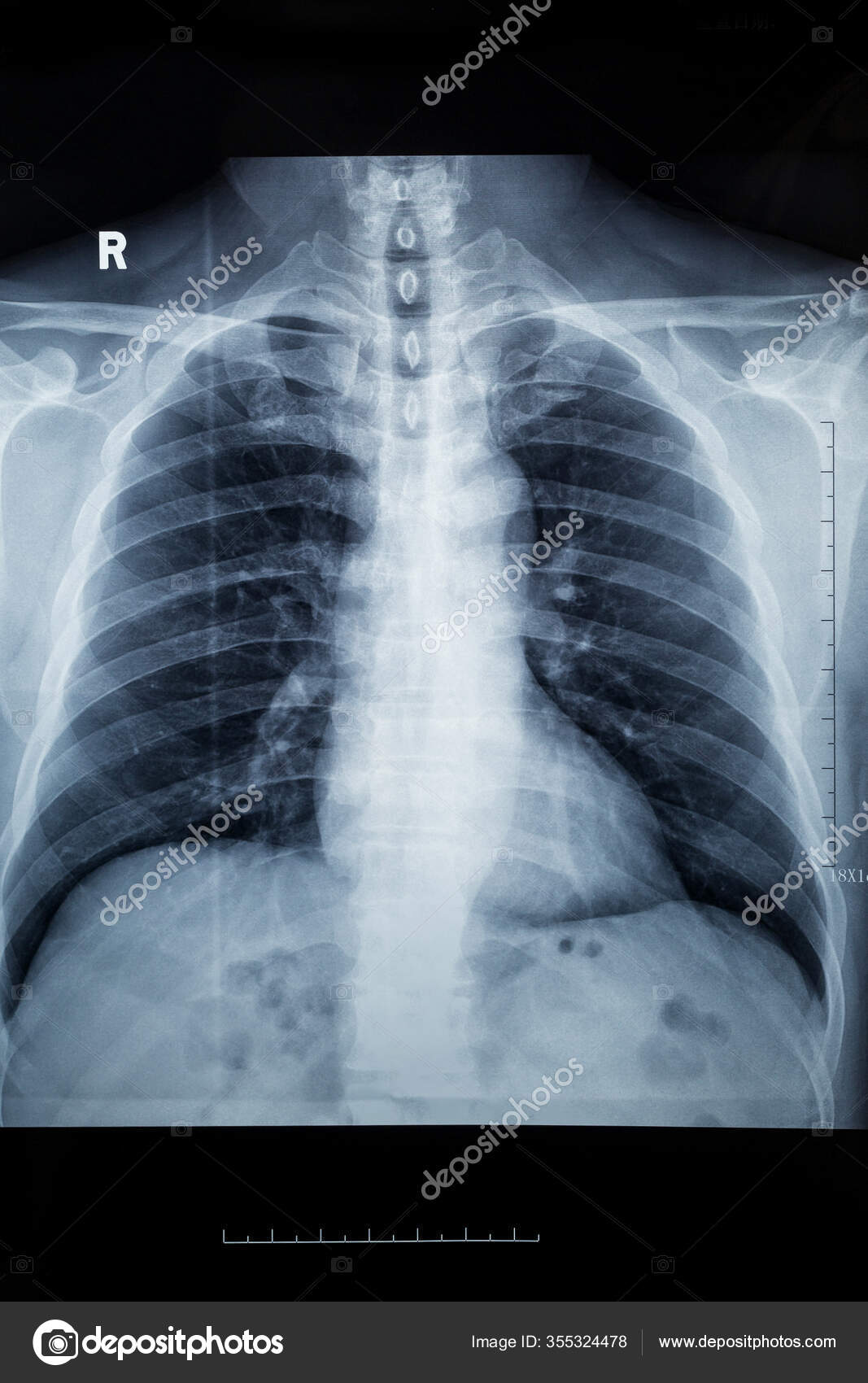 Scan Normal Lung — Stock Photo © badboydt7 #355324478