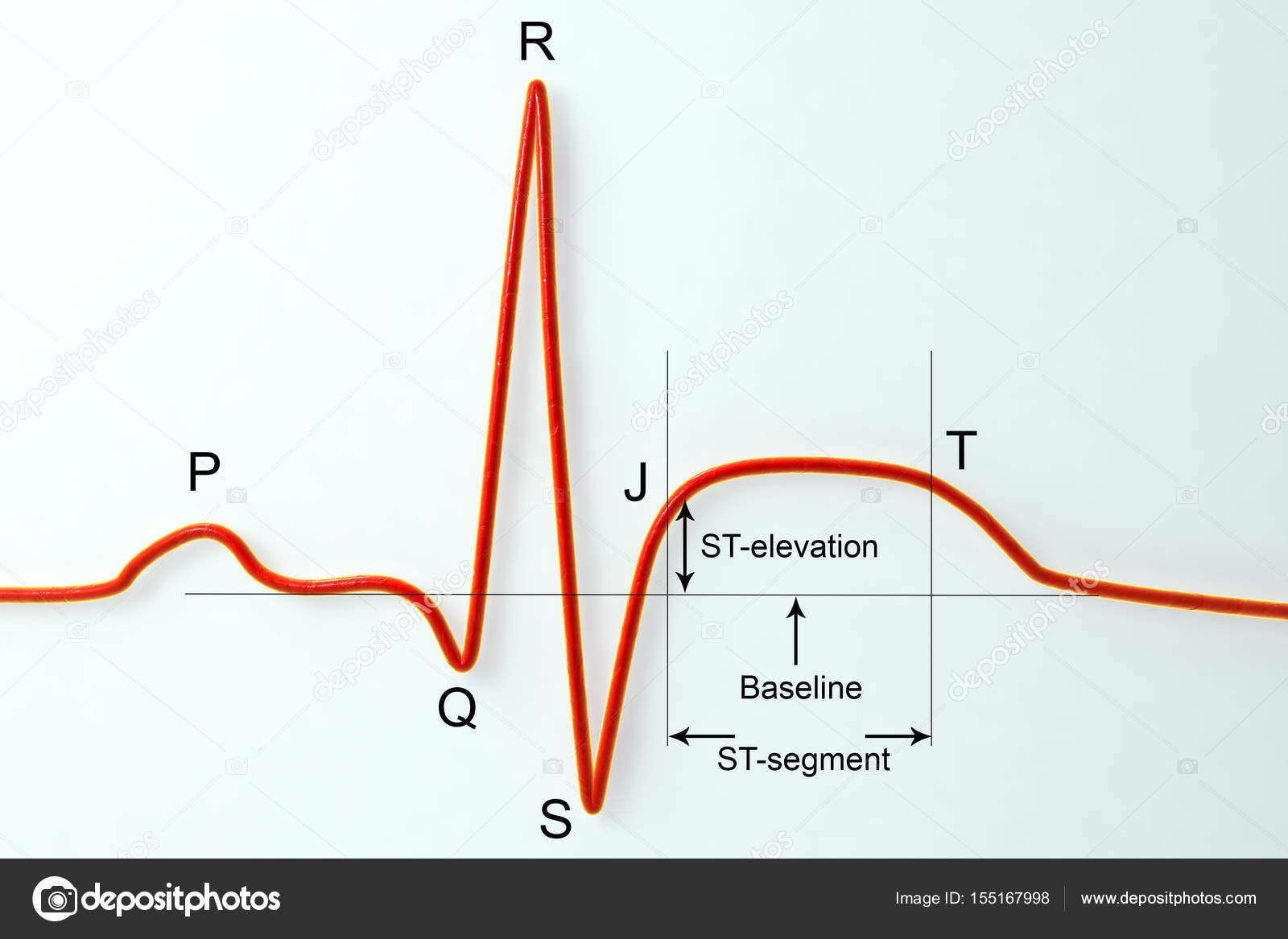 ECG dans l'infarctus du myocarde. Illustration montrant l'élévation ST ...
