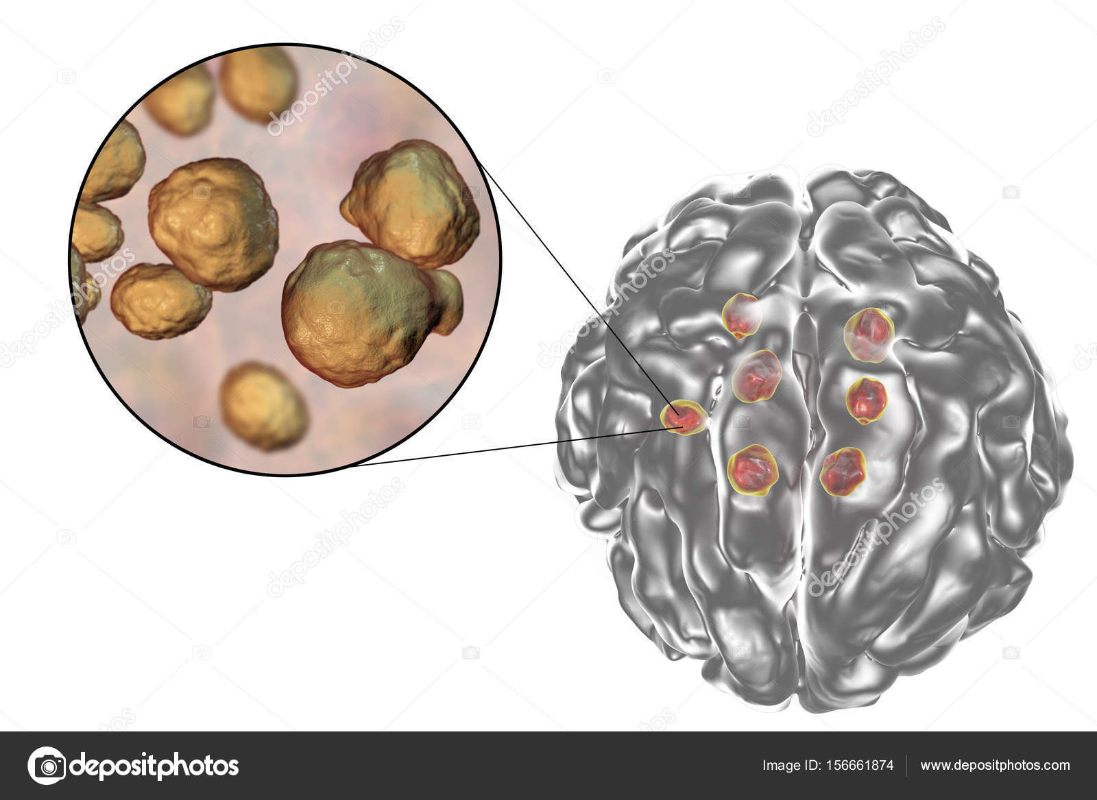 Multiple cryptococcal cysts in brain — Stock Photo © katerynakon #156661874