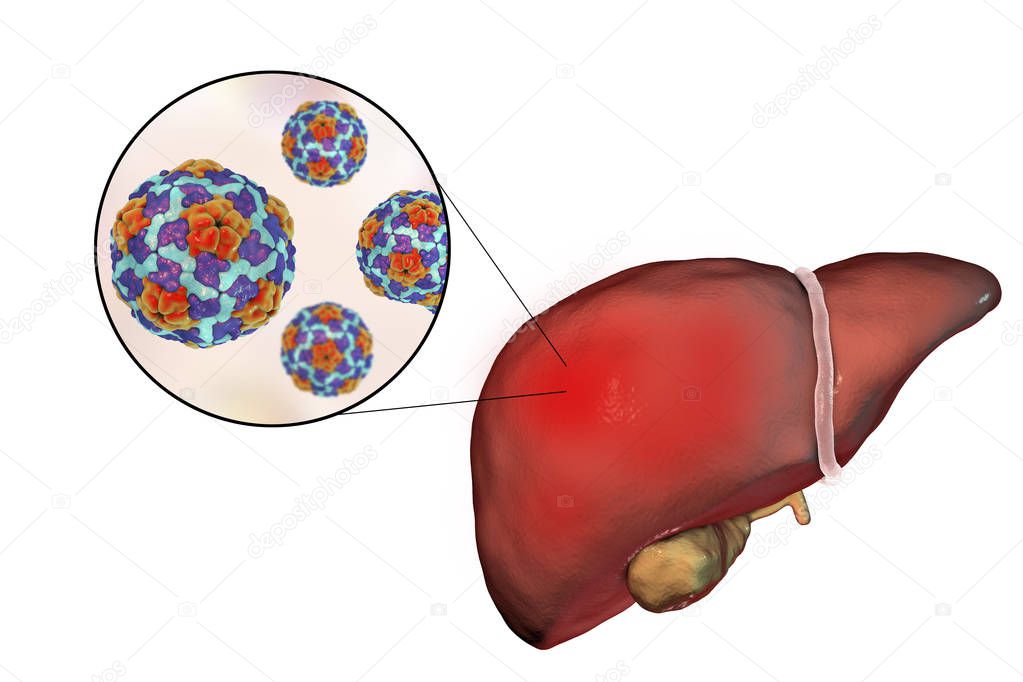 Liver with Hepatitis A infection and close-up view of Hepatitis A Virus ...