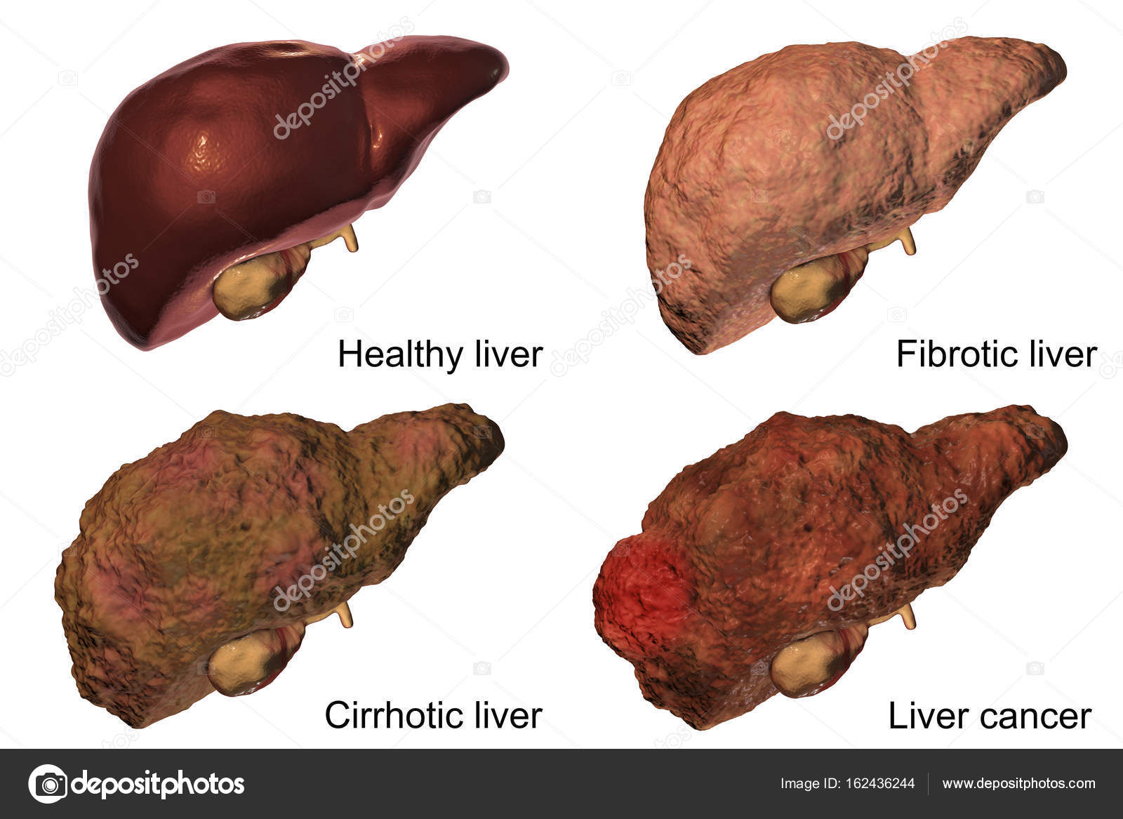 Healthy Liver Vs Unhealthy Liver