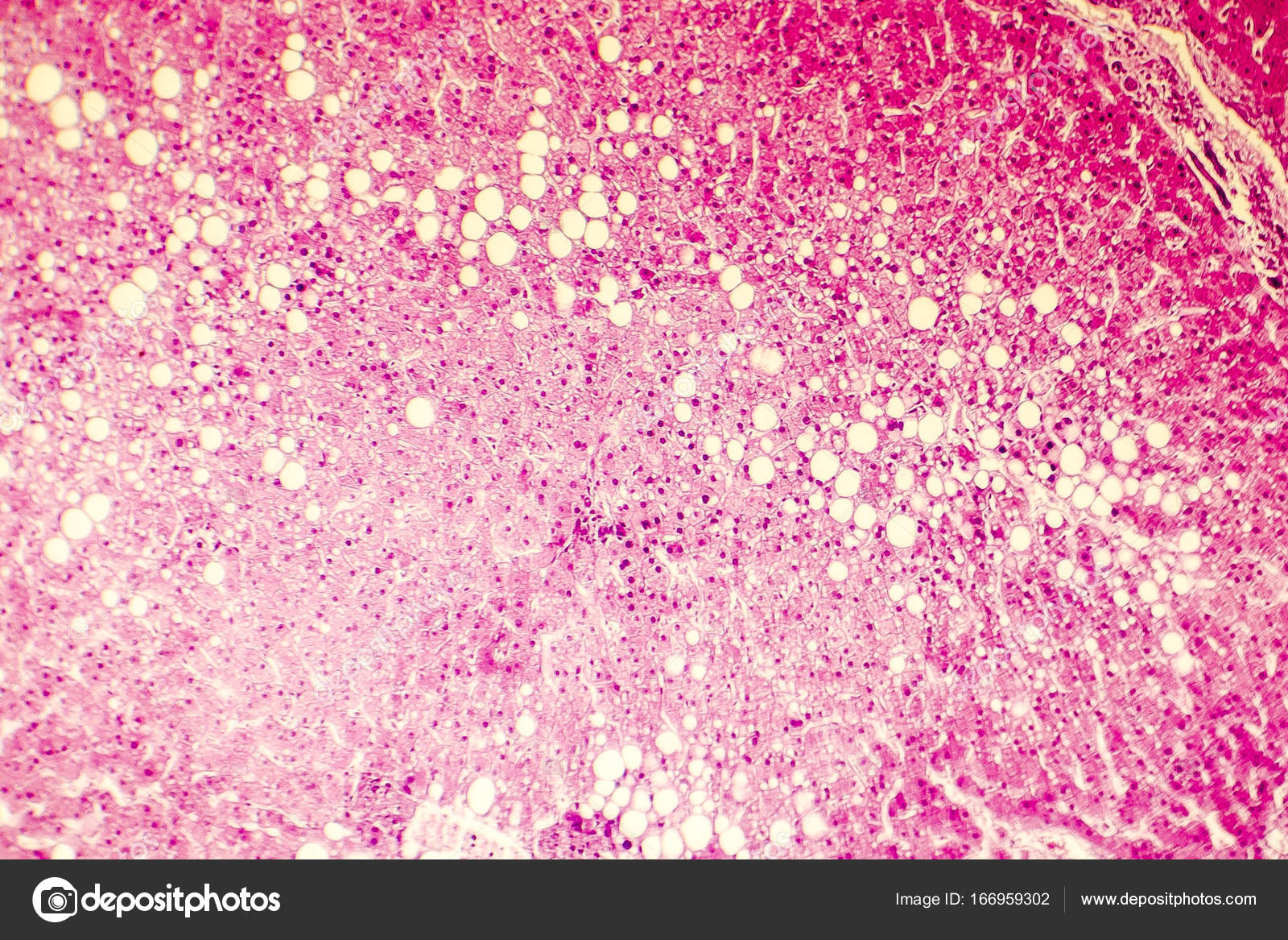 Light micrograph of a fatty liver Stock Photo by ©katerynakon 166959302