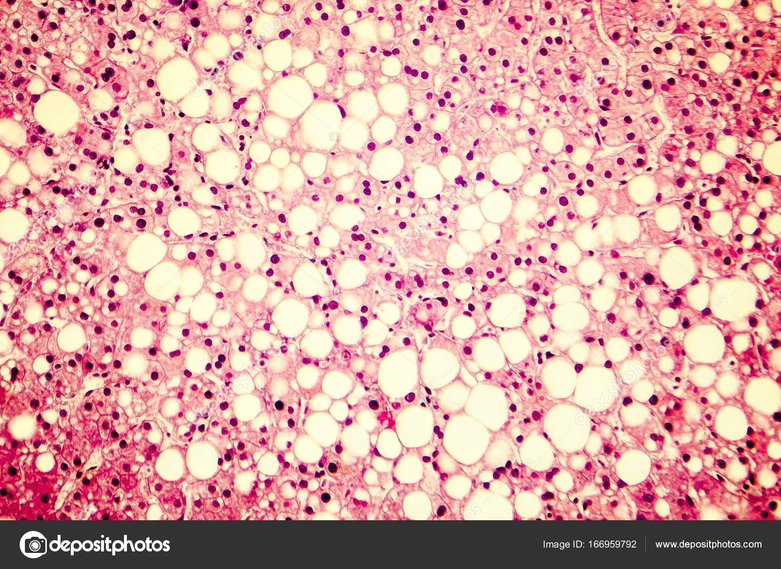 Light micrograph of a fatty liver Stock Photo by ©katerynakon 166959792