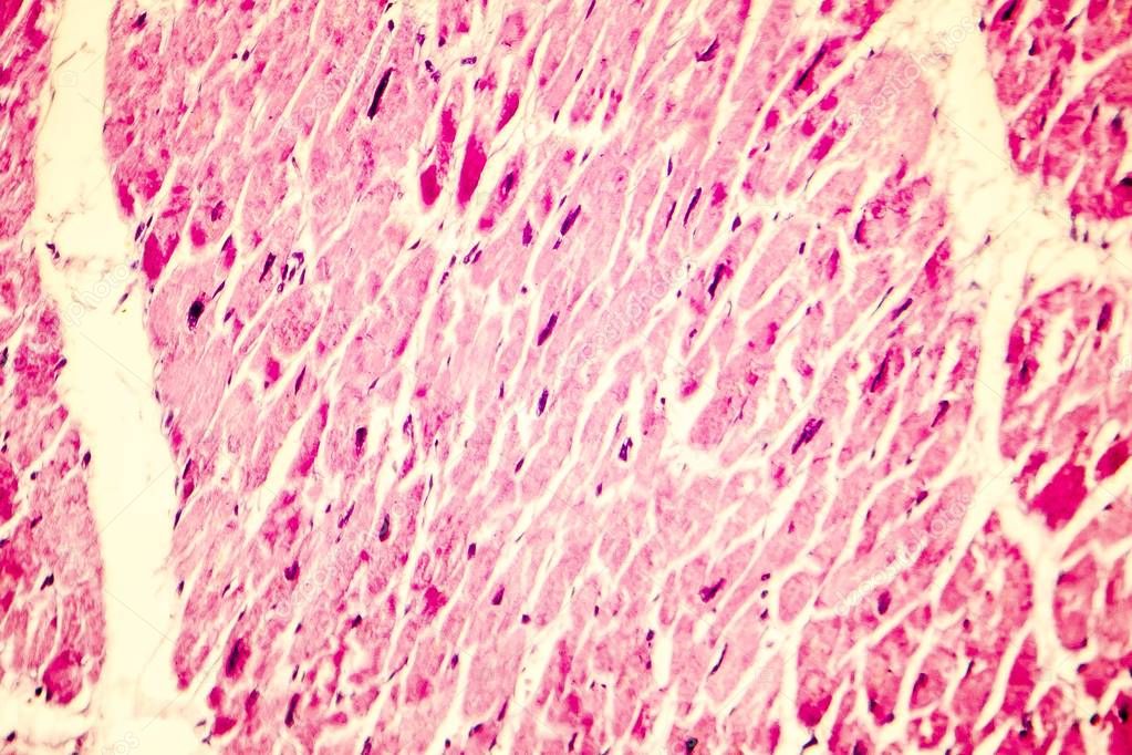 Fotomicrograma de hipertrofia cardíaca 2024