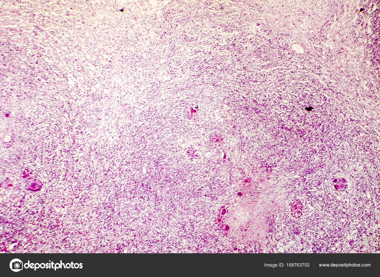 Necrosis licuefactiva del cerebro humano, fotomicrograma ligero — Foto ...