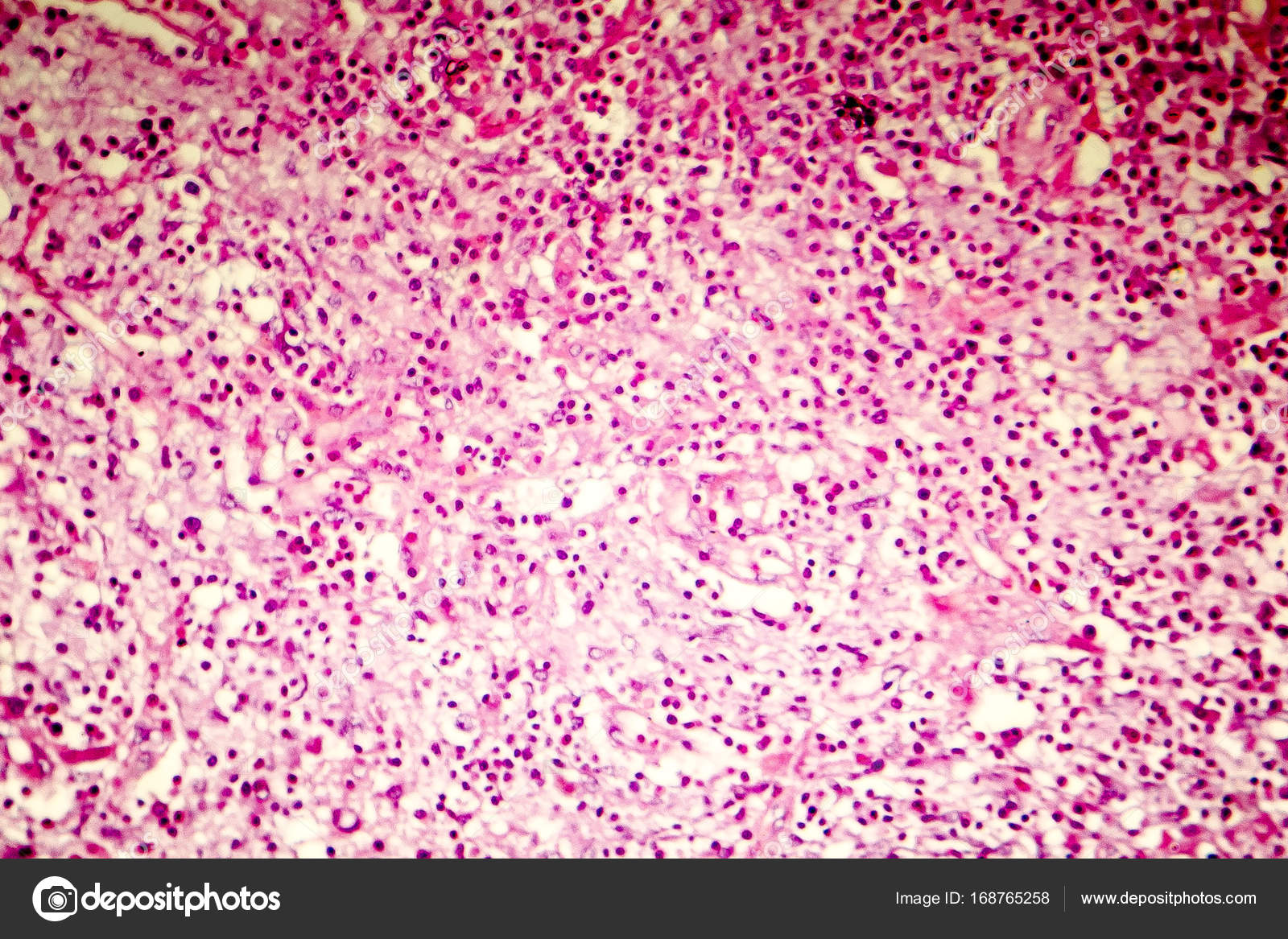 Cerebro De Necrose De Liquefacao Você Sabe Qual A Diferença Entre Um