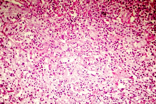 Caseous Necrosis Brain Caseous Necrosis Brain