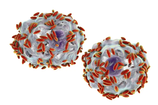 Microscopic diagnosis of bacterial vaginosis. Epithelial cell, so ...