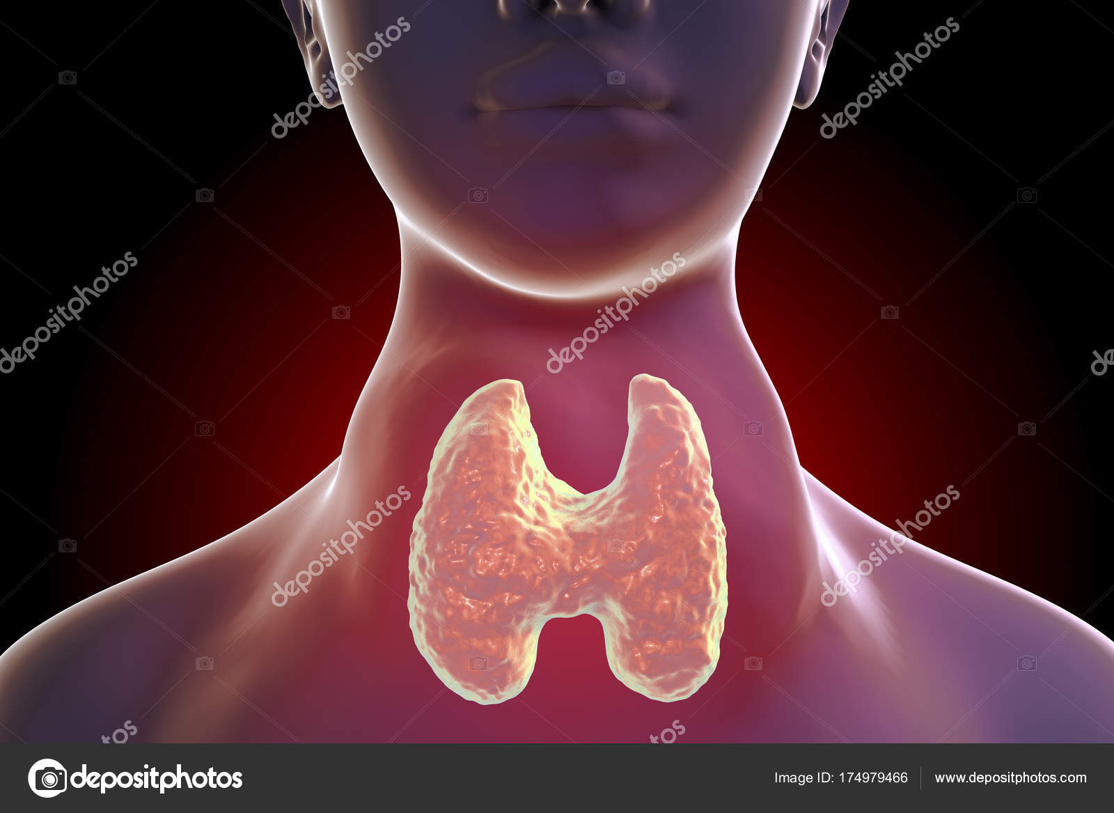 Toxic diffuse goiter, hyperthyroidism ⬇ Stock Photo, Image by ...