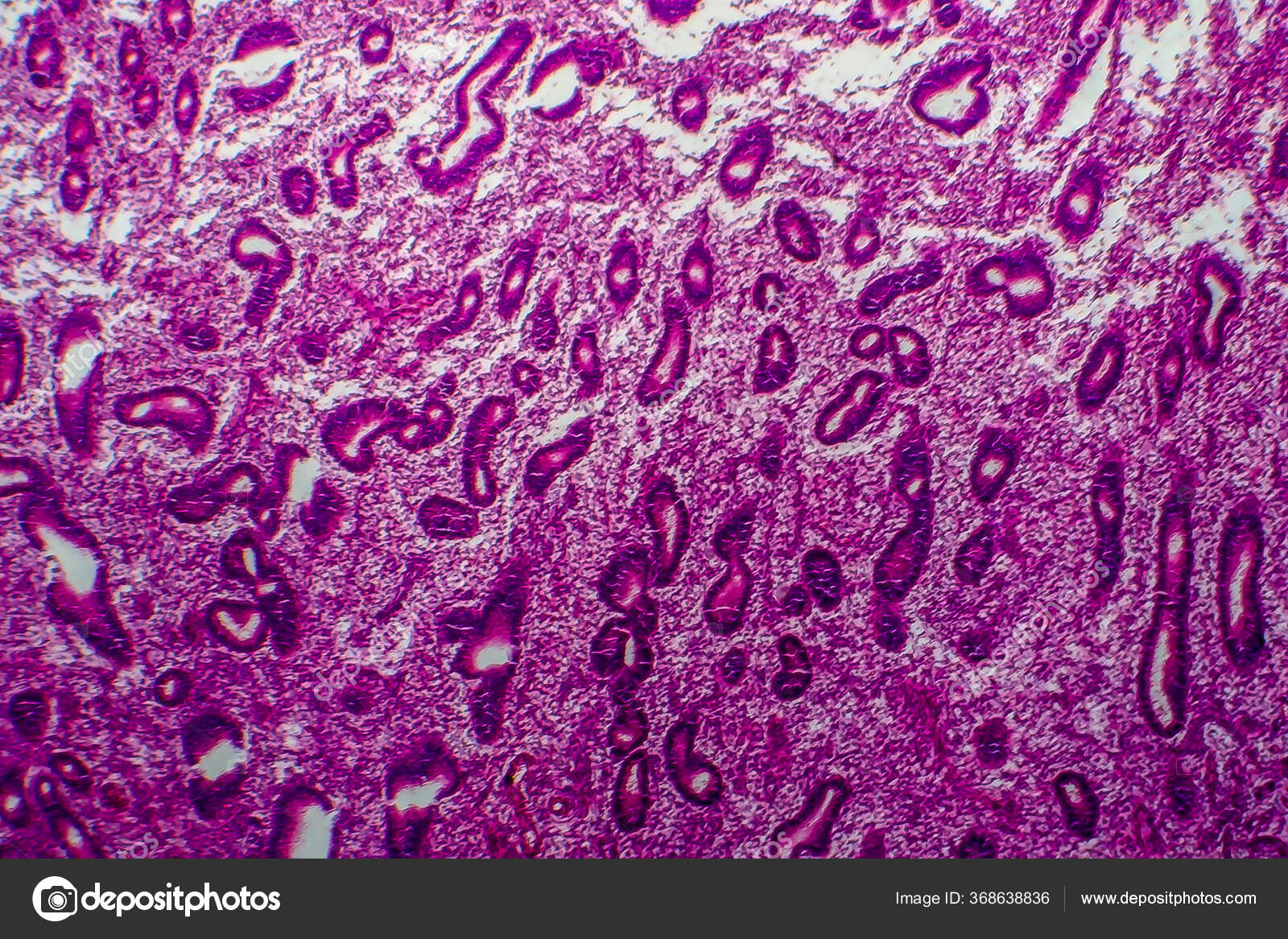 Endometrial Hyperplasia Light Micrograph Photo Microscope — Stock Photo ...