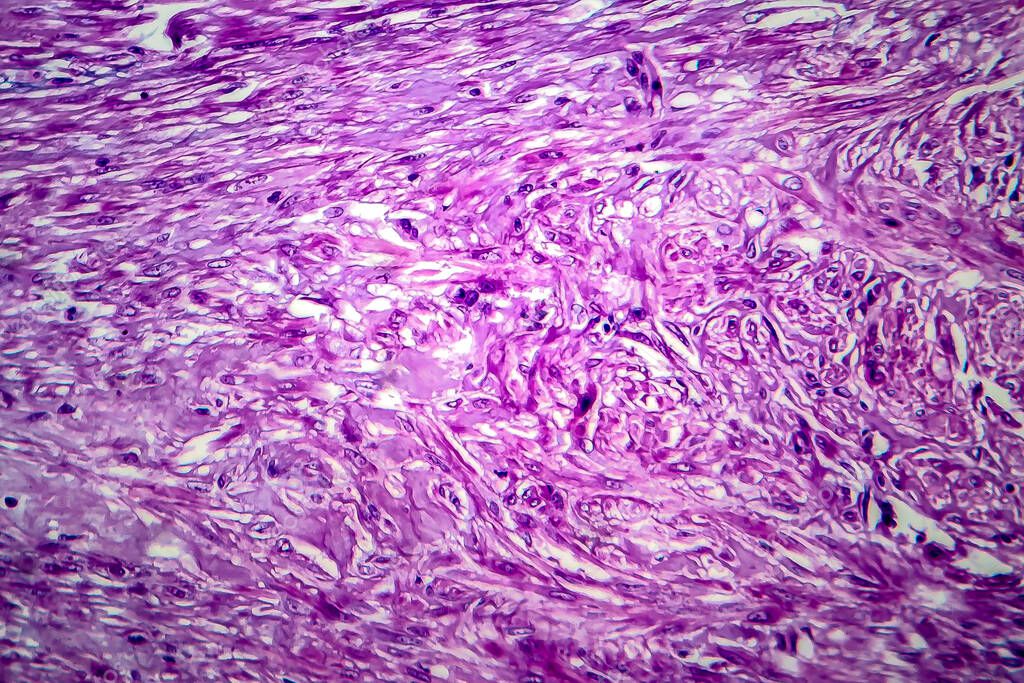 Leiomioma uterino, tambi n conocido como fibromas, un tumor benigno del ...