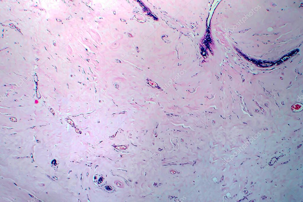 Adenofibroma de útero, micrografía ligera, foto bajo el microscopio ...