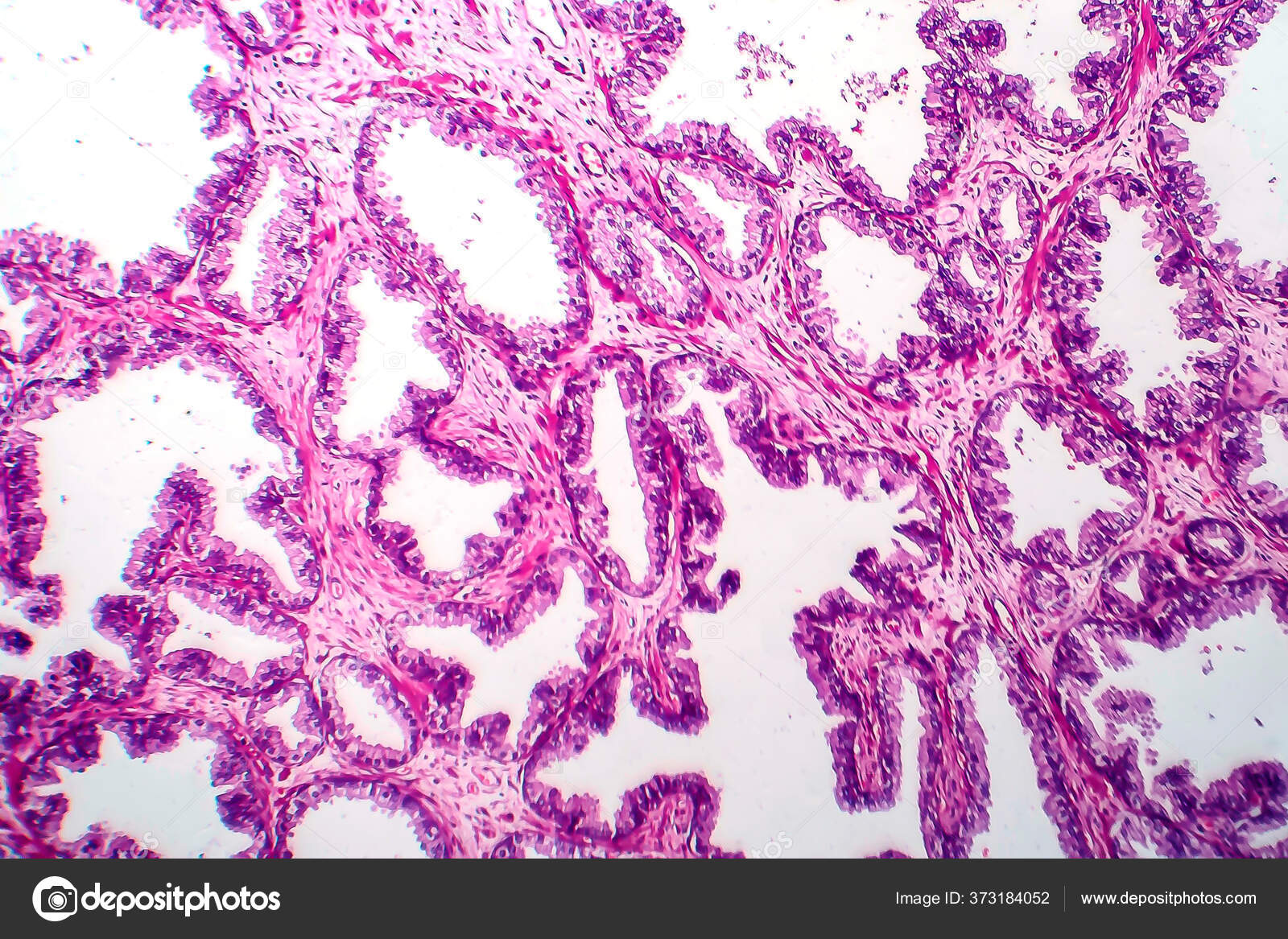Prostate Cancer Light Micrograph Photo Microscope — Stock Photo ...