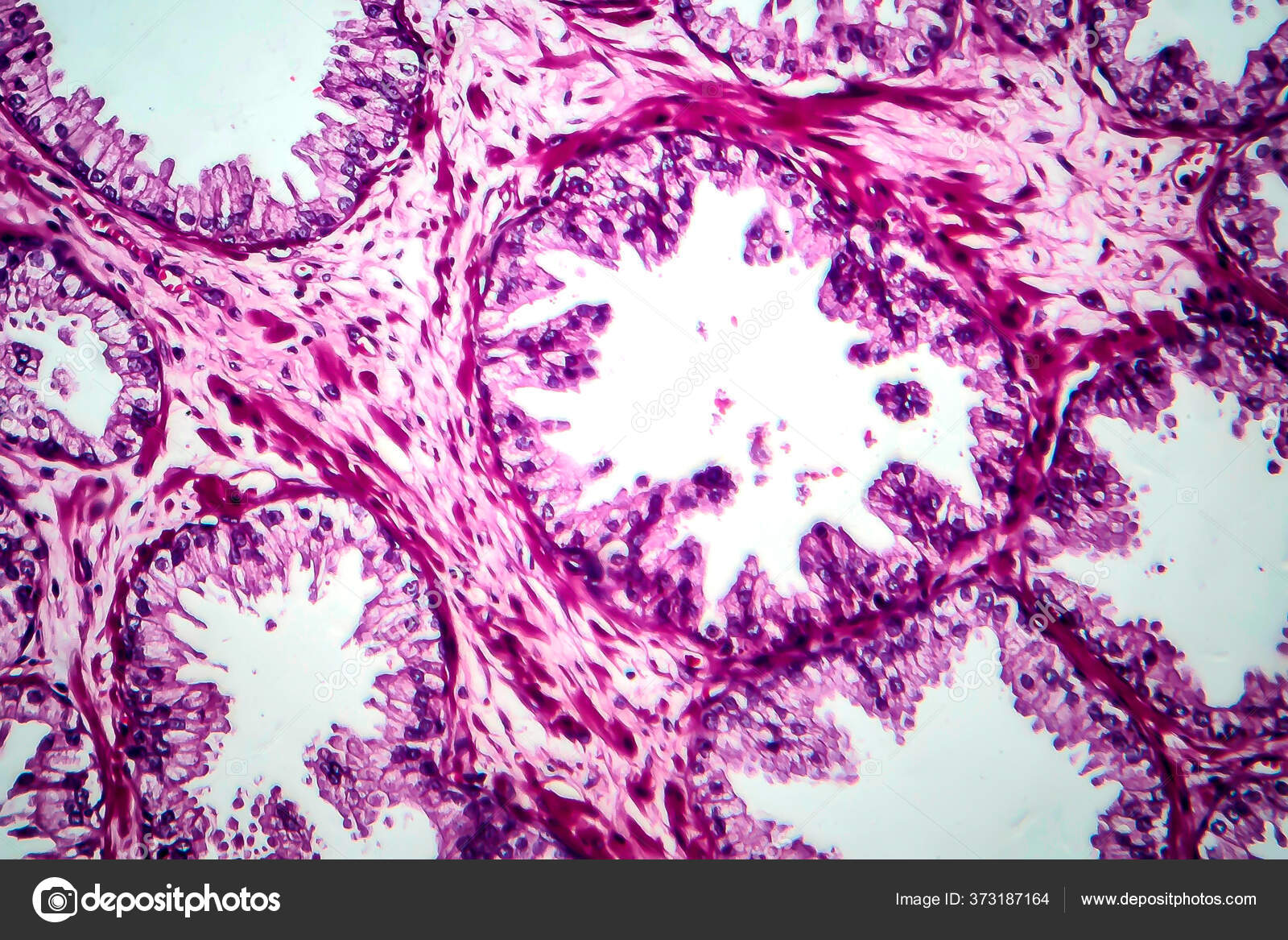 Prostate Cancer Light Micrograph Photo Microscope — Stock Photo ...