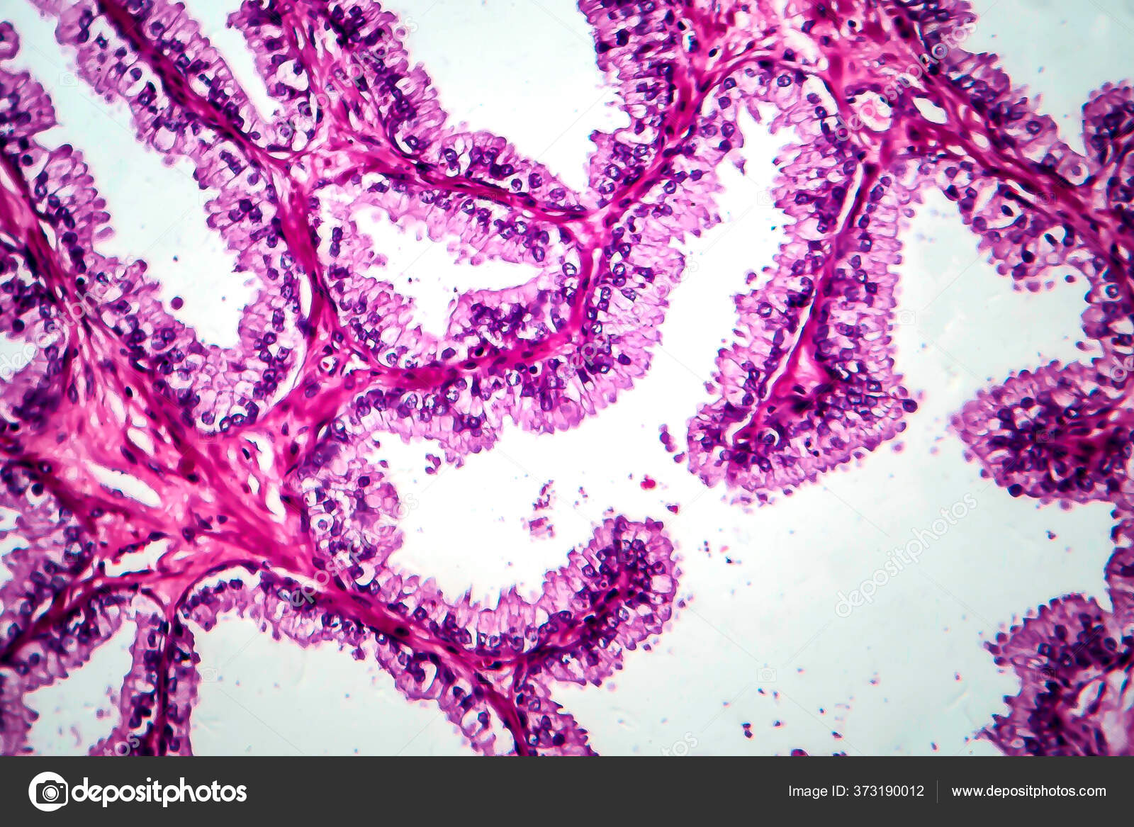 Prostate Cancer Light Micrograph Photo Microscope Stock Photo by ...