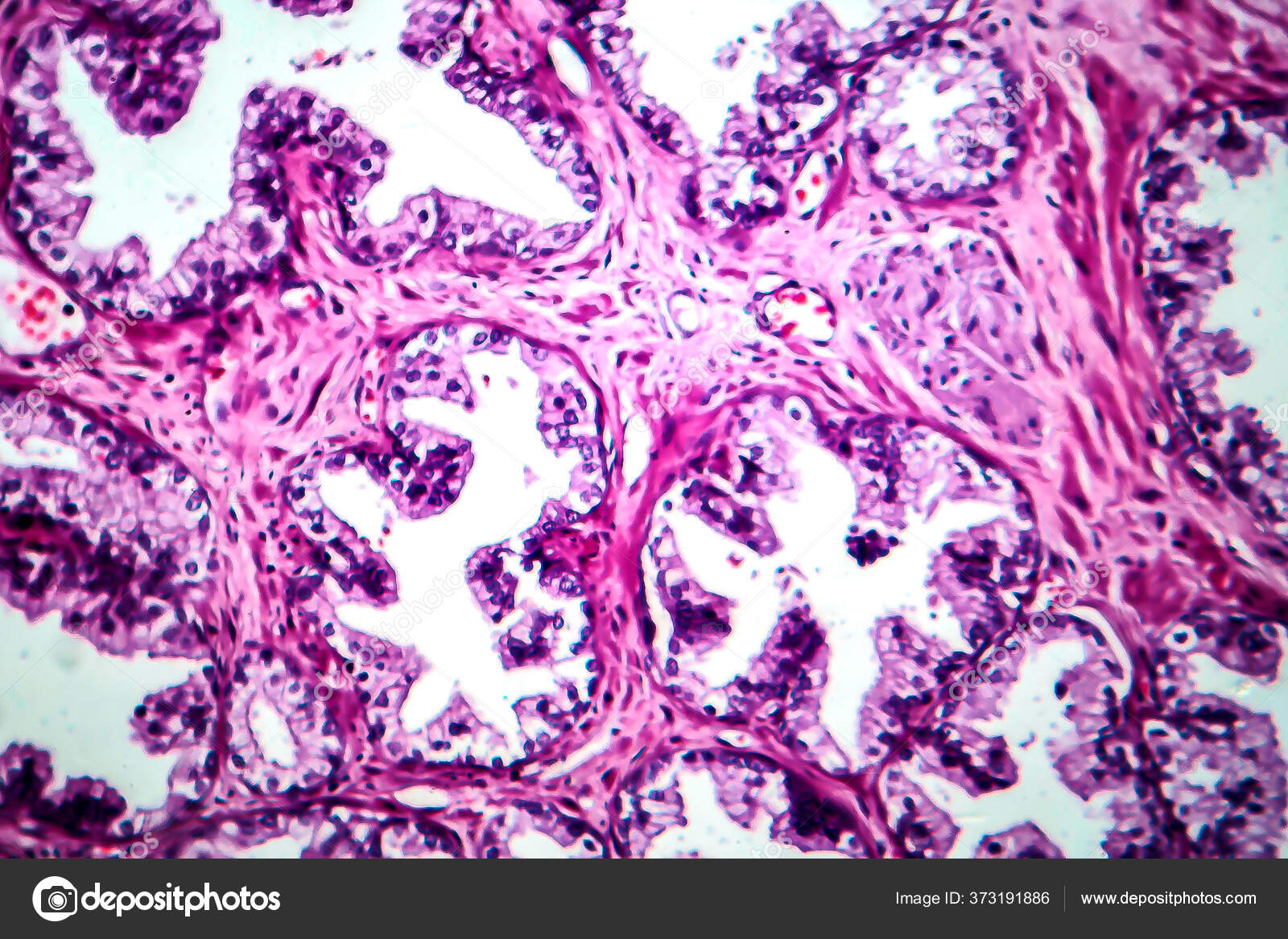 Prostate Cancer Light Micrograph Photo Microscope — Stock Photo ...