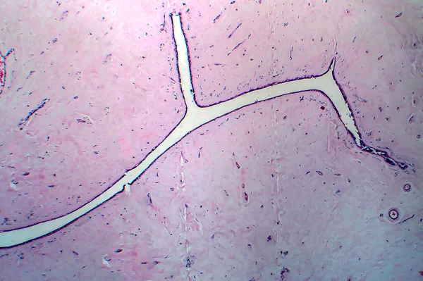 Adenofibroma de útero, micrografía ligera, foto bajo el microscopio ...