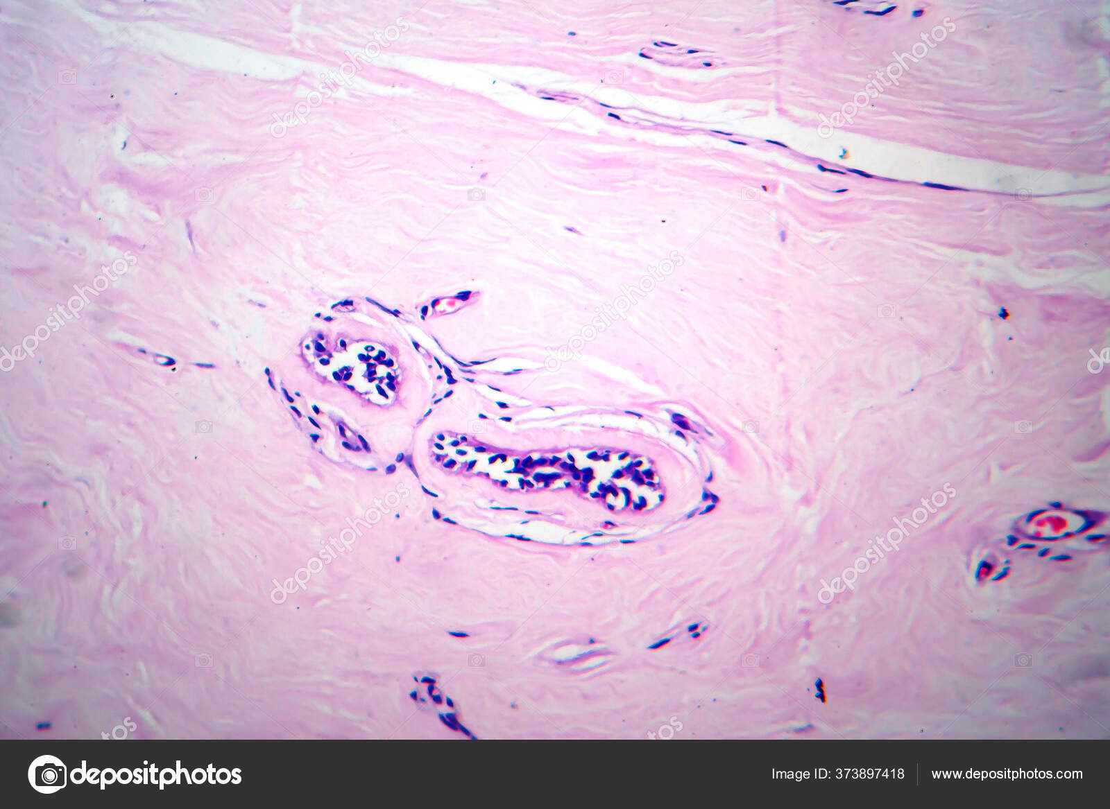 Uterus Adenofibroma Light Micrograph Photo Microscope Rare Benign Tumor ...