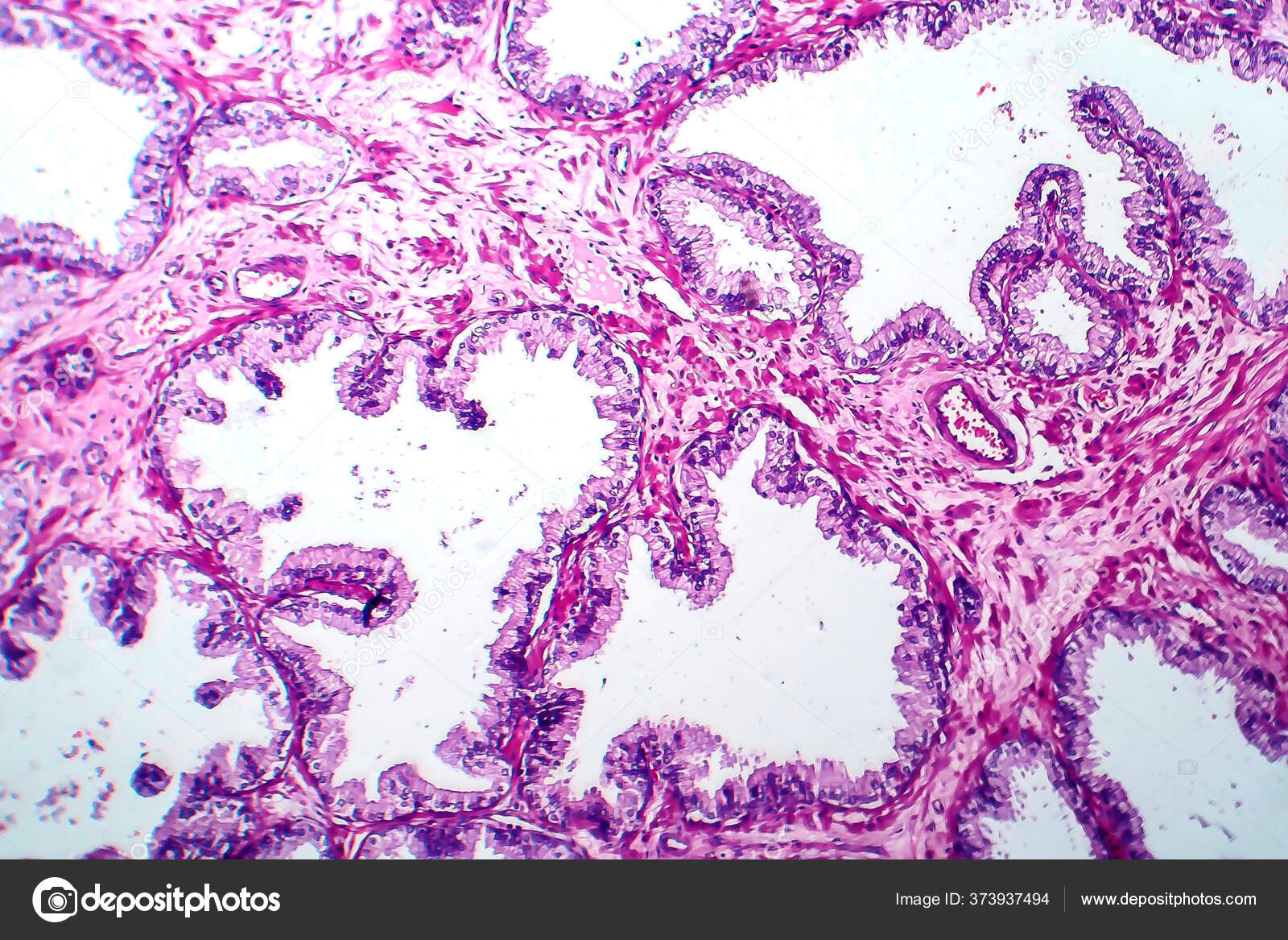 Prostate Cancer Light Micrograph Photo Microscope Stock Photo by ...