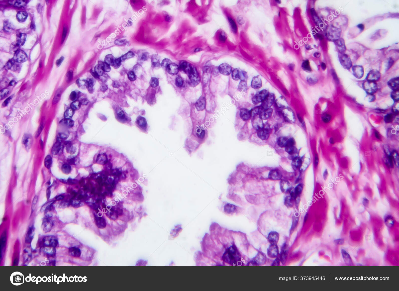 Prostate Cancer Light Micrograph Photo Microscope — Stock Photo ...