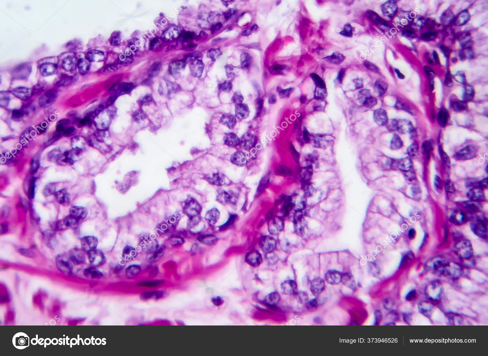 Prostate Cancer Light Micrograph Photo Microscope — Stock Photo ...