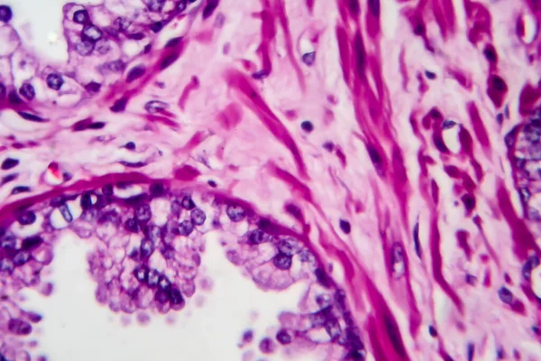 Prostate Cancer Light Micrograph Photo Microscope — Stock Photo ...