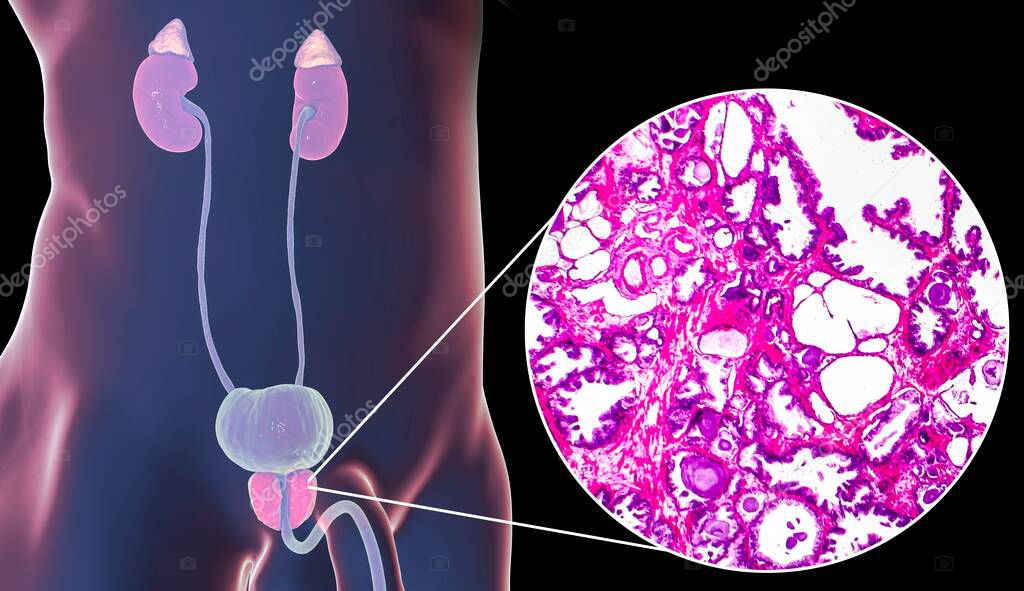 Hiperplasia prostática benigna, ilustración 3D que muestra ...