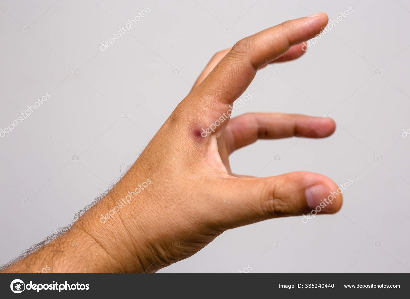 Photo of a scorpion sting in a person's hand. Scorpion sting, danger ...