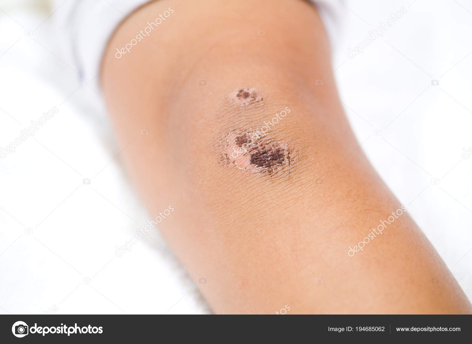 Scab On Knee