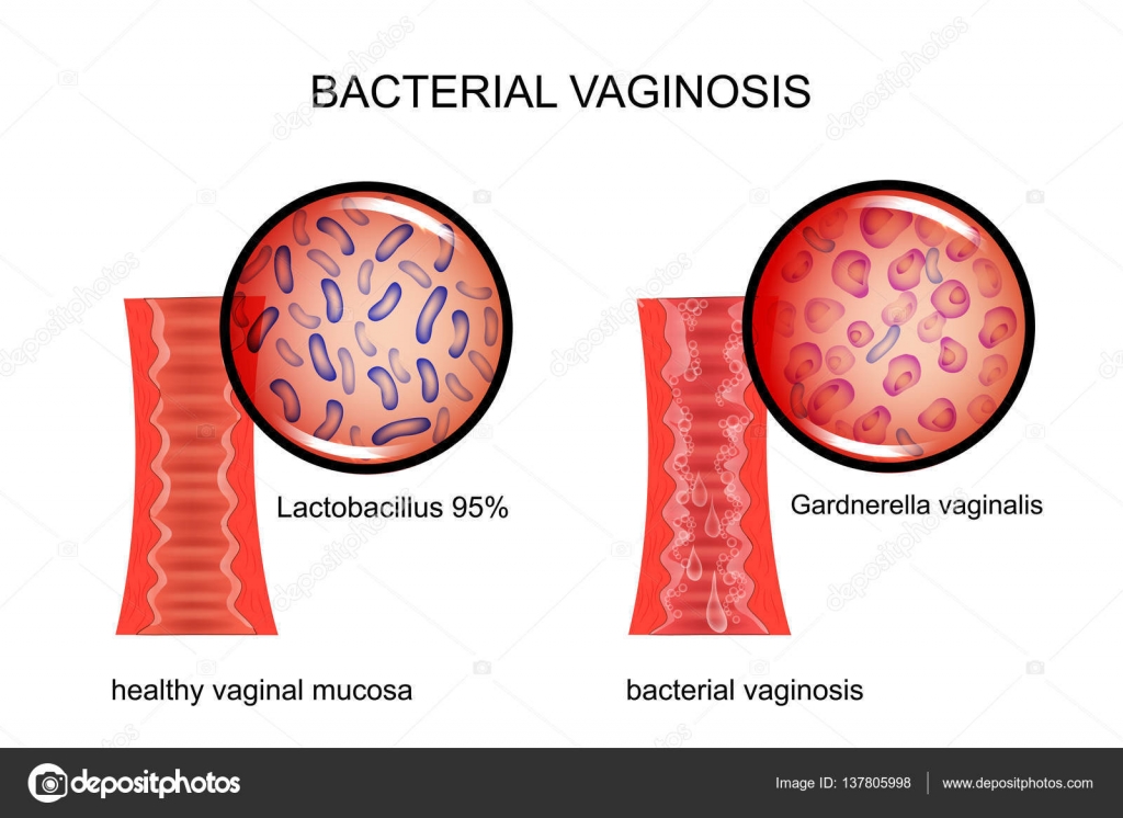 Bacterial vaginosis. the vagina and the causative agent Stock Vector Image by ©Artemida-psy ...