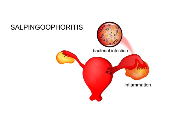 Enfermedad inflamatoria pélvica imágenes de stock de arte vectorial ...