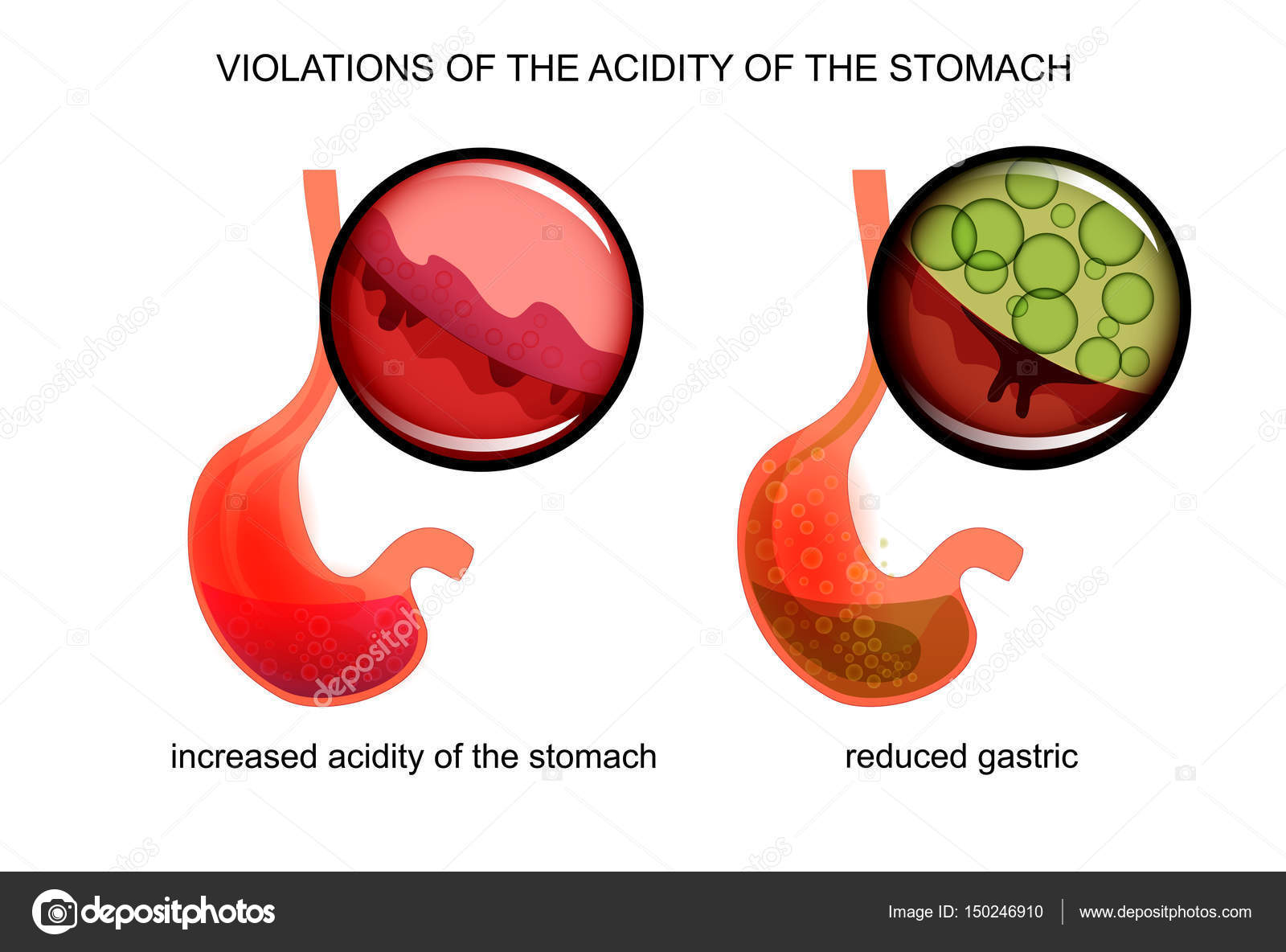 High and low acidity of the stomach Stock Illustration by ©Artemida-psy ...