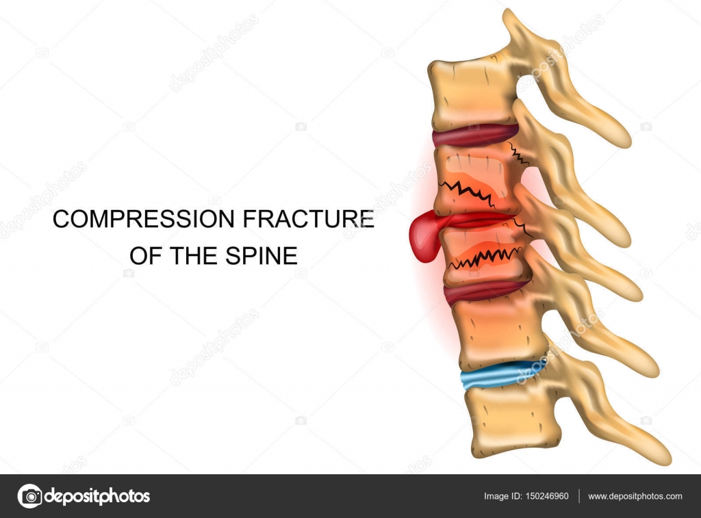 Compression Fracture Diagram