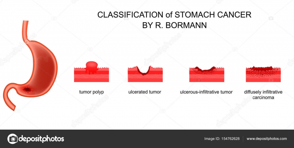 Classification of gastric cancer — Stock Vector © Artemida-psy #154762628 Classification of gastric cancer — Stock Vector © Artemida-psy #154762628