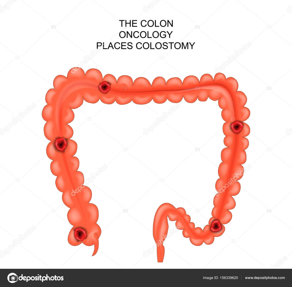 Colostomia. colocar intervenção cirúrgica Vetor de ©Artemida-psy 156339620