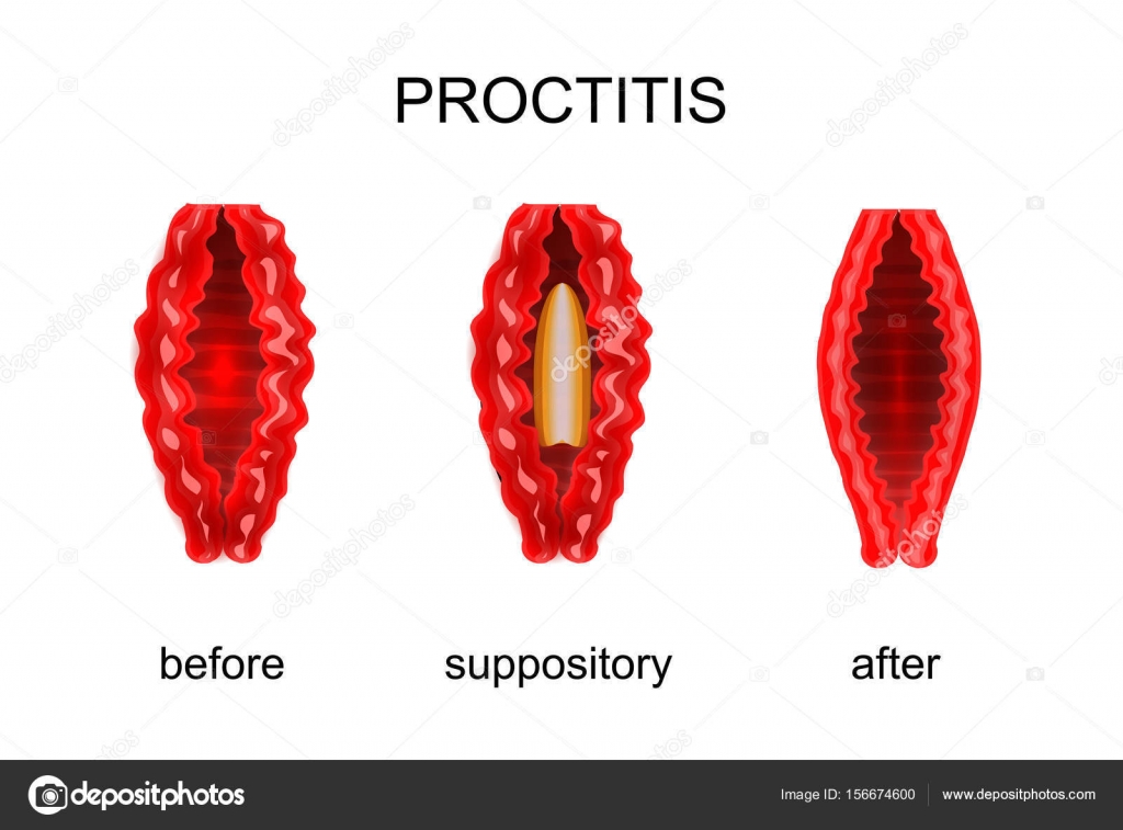 Proctitis. before and after treatment of rectal suppositories — Stock ...