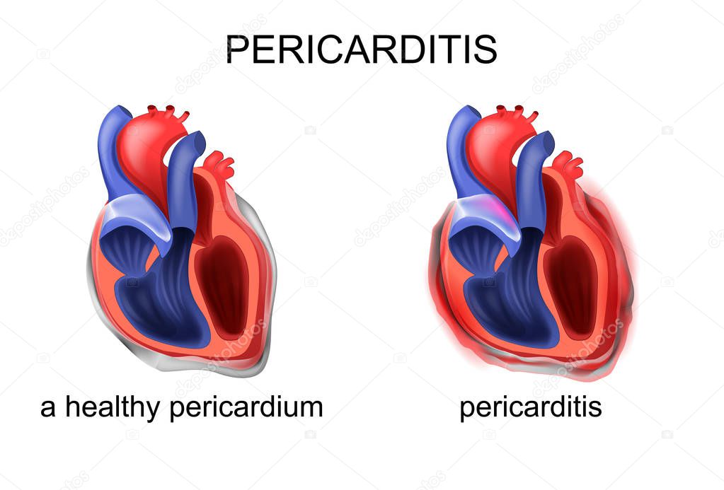Un pericardio sano, pericarditis Vector de Stock de ©Artemida-psy 161594442