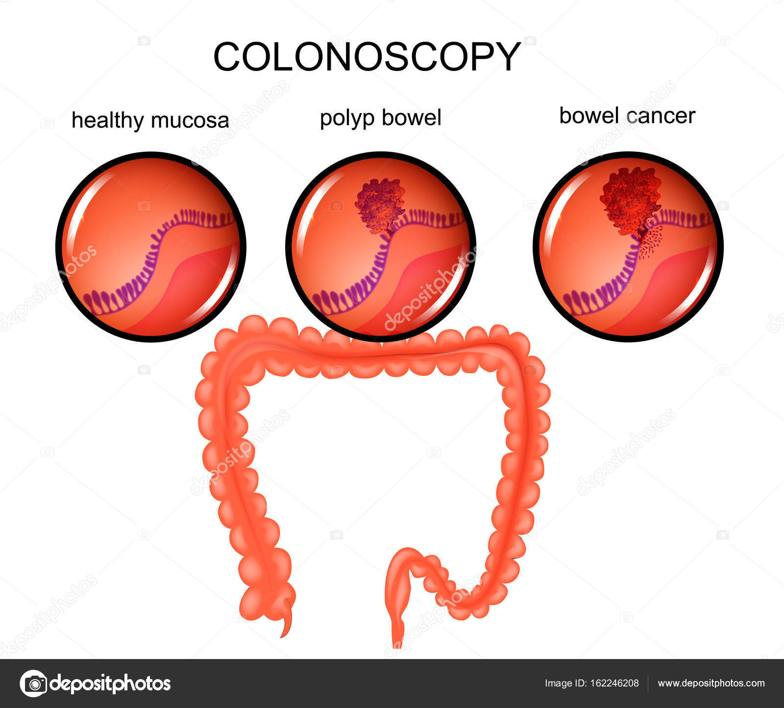 Polyp of the large intestine and cancer Stock Vector Image by ©Artemida ...