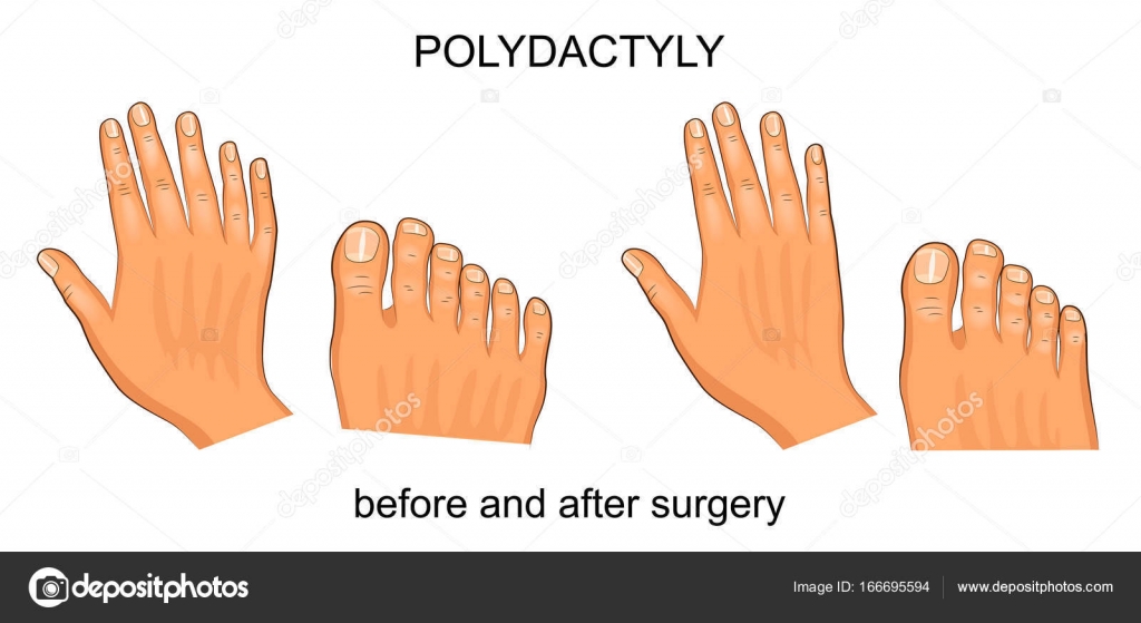 Polydactyly before and after surgery — Stock Vector © Artemida-psy ...