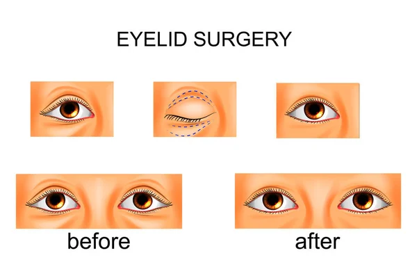 Blepharoplasty of the overhanging eyelid Stock Vector Image by ...