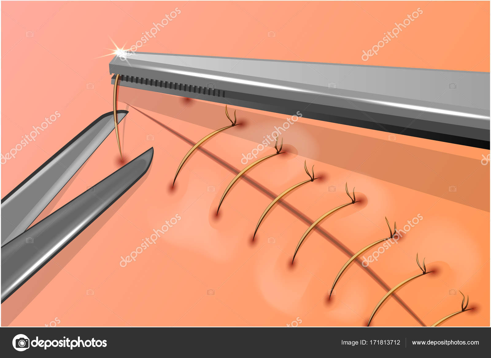Removal of surgical stitches Stock Vector Image by ©Artemida-psy #171813712