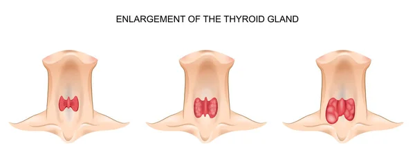 Thyroid gland Vector Art Stock Images | Depositphotos