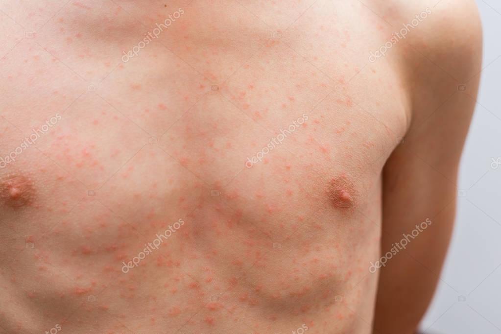 niño con dermatitis problema de erupción, erupción alérgica en su cuerpo. 2025