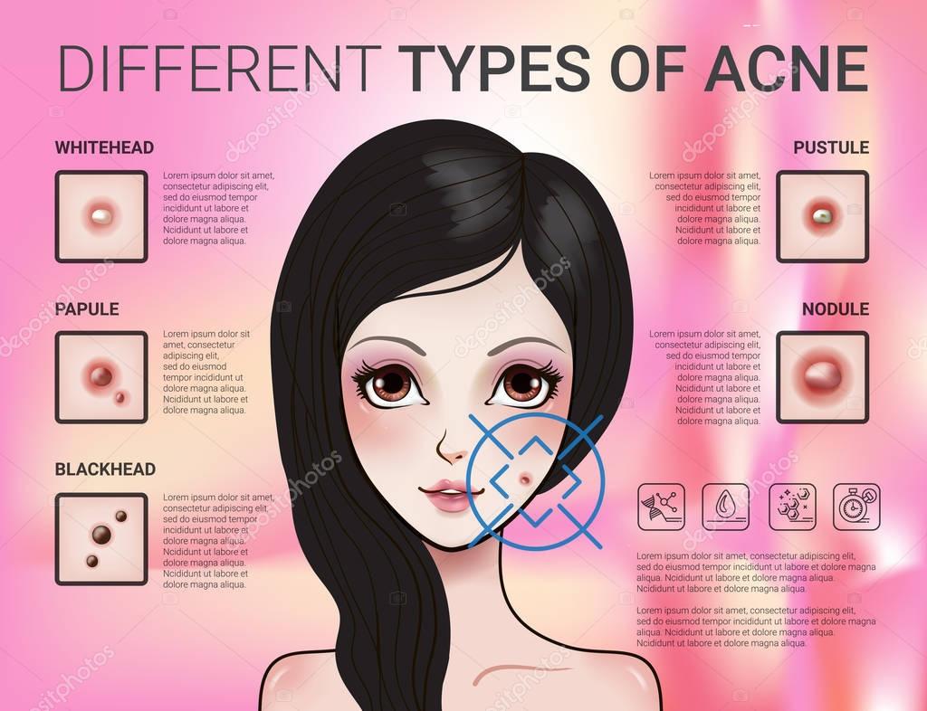 Infografías de diferentes tipos de acné en la piel 2023