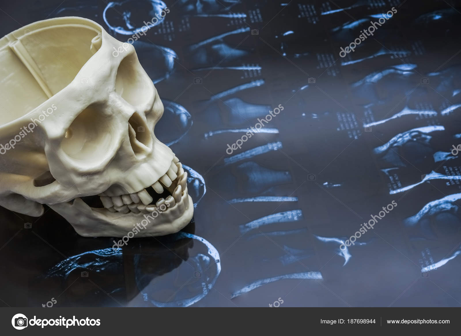 Radiography Skull Scan Showing Fracture Frontal Bone — Stock Photo ...