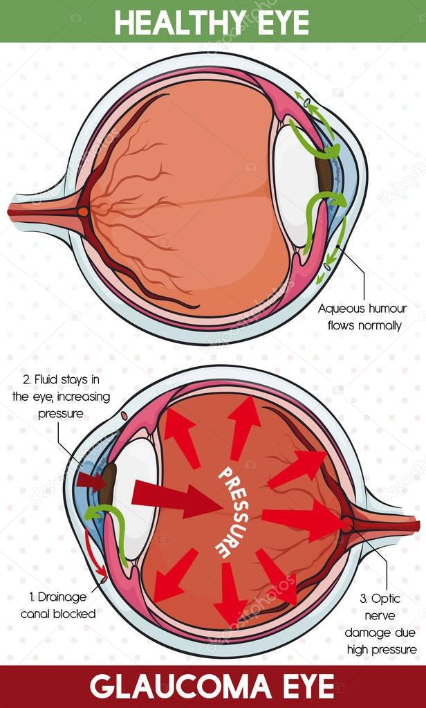 Información Comparada Entre Ojo Saludable Y Ojo De Glaucoma